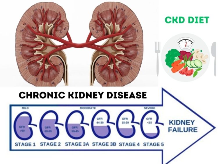 CKD DIET :Guide To Managing Chronic Kidney Disease Naturally